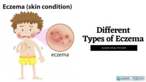 Different Types of Eczema | How to Identify Eczema | Eczema Cream