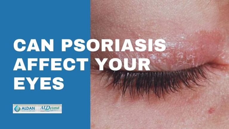 Can Psoriasis Affect Your Eyes [Psoriatic Arthritis Eye Symptoms]