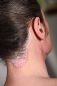 Scalp and Behind Ear Psoriasis [Removing Psoriasis from Ears ]