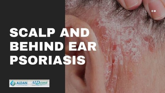 Scalp and Behind Ear Psoriasis [Removing Psoriasis from Ears ]