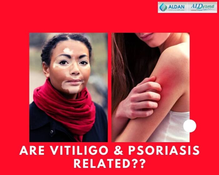Are Vitiligo and Psoriasis Related? - The Cure For Vitiligo Found