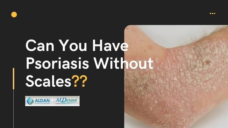 Can You Have Psoriasis Without Scales- What Causes Psoriasis