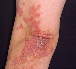 Can You Have Psoriasis Without Scales- What Causes Psoriasis
