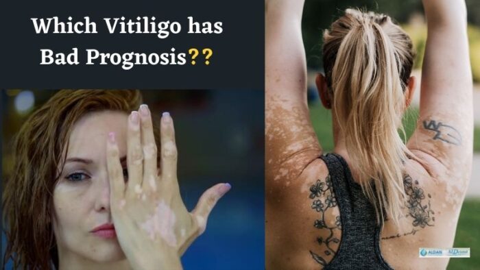 Which Vitiligo Has Bad Prognosis "How to Stop Vitiligo from Spreading?"